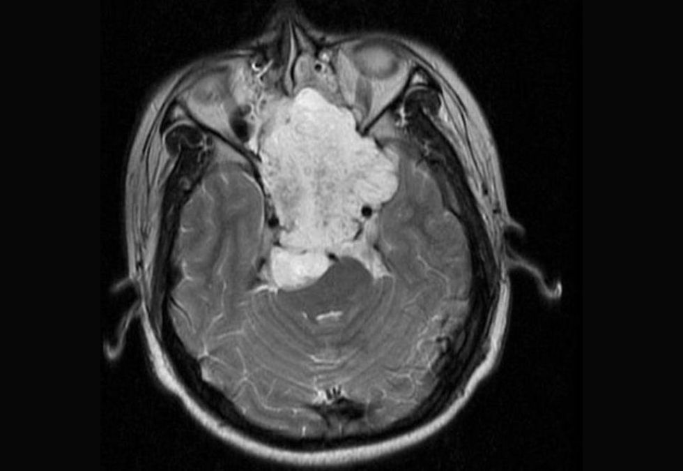 8 Rarest Cancers in World - Oldest.org