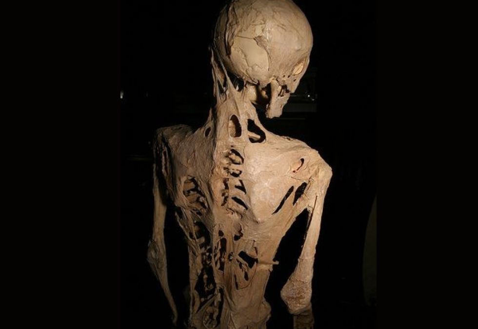 10 Rarest Diseases In The World - Oldest.org